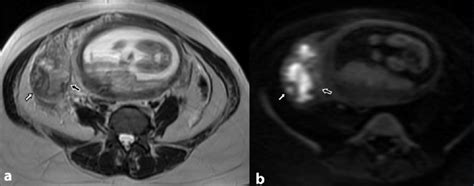 A 23 Year Old Pregnant Patient In 21st Week Of Gestation Perforated