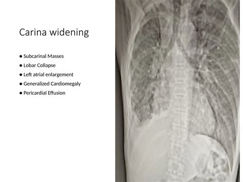Pleural Based Malignant Mesotheliomapptx