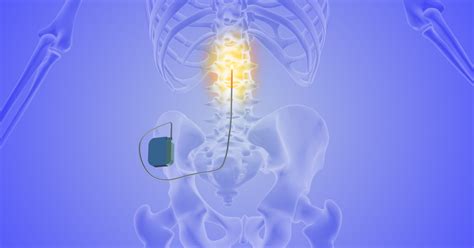 The Imaginary Effect Of Epidural Spinal Cord Stimulation Tidsskrift