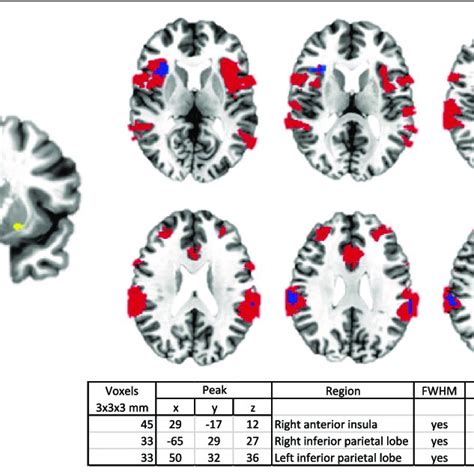 Right Dorsal Striatal Binding Potential By Functional Connectivity Download Scientific Diagram