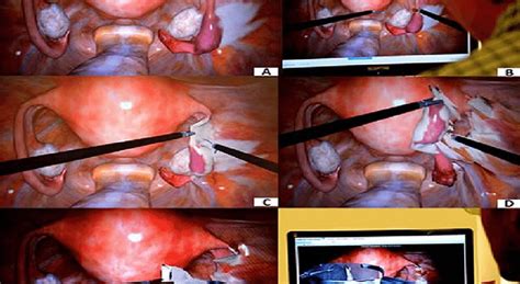 Laparoscopic Salpingectomy For Ectopic Pregnancy Nile Valley Mother