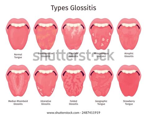 Glossitis Scarlet Tongue Disease Types Human Stock Vector Royalty Free 2487411919 Shutterstock