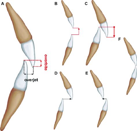 Illustration Of Upper And Lower Incisor Relationships A Ideal Download Scientific Diagram