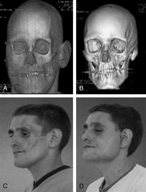 A Preoperative Soft Tissue Computed Tomography Showing Atrophy Of