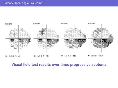 Ppt Glaucoma Diagnosis And Management Powerpoint Presentation Free
