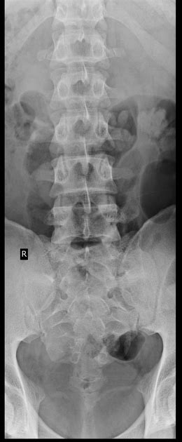 Transverse Process Fracture X Ray
