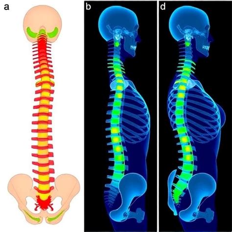 Bipolar Configurations In Adult Spine Deformity Analysis