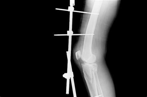 Premium Photo Show Fracture Tibia And Fibula X Ray Image Of Fracture Leg With Implant