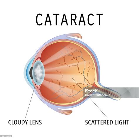 Human Eye With Cataract Eyeball With A Cloudy Lens Stock Illustration