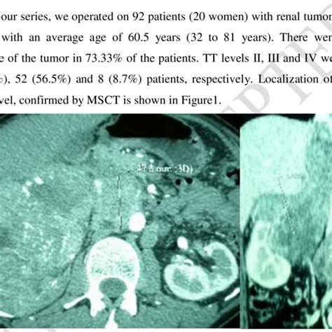 Multi Slice Computed Tomography Msct Cavography The Inferior Vena Download Scientific