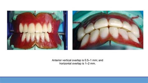 Anterior Teeth Arrangement Ppt