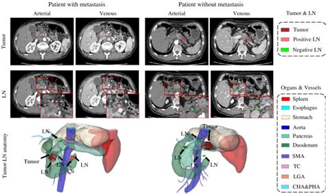 A Deep Local Attention Network For Pre Operative Lymph Node Metastasis Prediction In Pancreatic