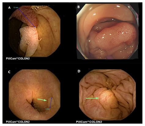 Colonoscopy Camera Size