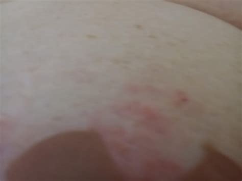 I Am Having A Allergic Reaction To The Adhesive For The G7 If I Was To