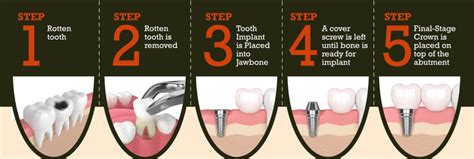 Dental Implant Procedure Step By Step Overview