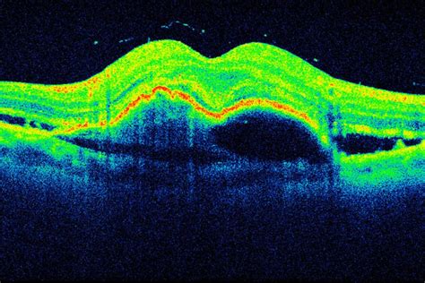 Amdcolour Octedited Retina Doctor