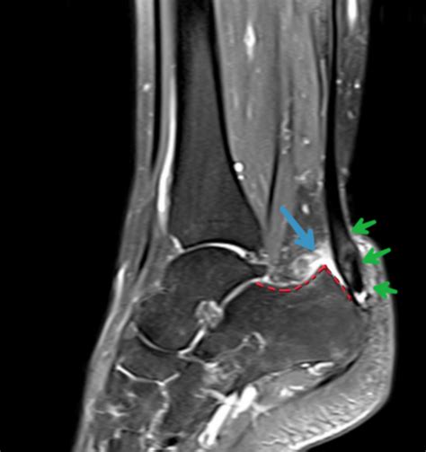 Pump Bump Mri At Harry Stedman Blog