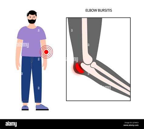 Behandlung Bursitis Ellenbogen Bursitis Olecrani Diagnose Kose