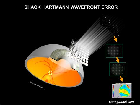 Wavefront Sensing Docteur Damien Gatinel