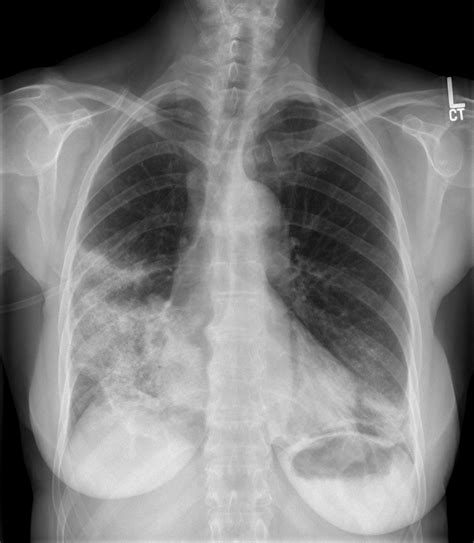 Radiographic Appearance Of Bronchiolitis Obliterans Organizing My XXX Hot Girl