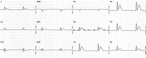 Hypercalcemia Of Malignancy Em Sim Cases