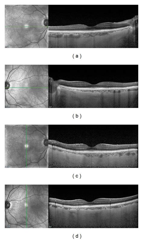 Influence Of Scleral Buckling Surgery With Encircling Band On Subfoveal Choroidal Thickness In