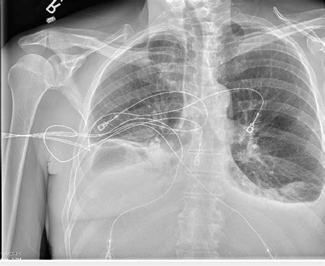 Chest X Ray With Bibasilar Consolidations With Bilateral Pleural Download Scientific Diagram