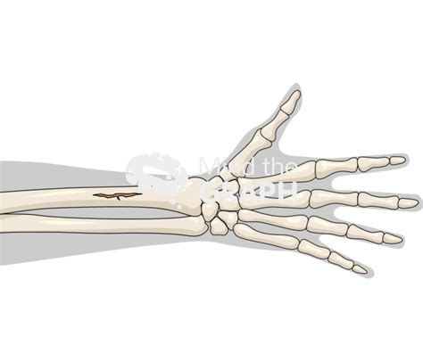 Radius Fracture 1 Body