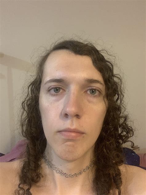 Sara Danker Ffs Results 2 Weeks Post Op Uhealth Miami Fl R