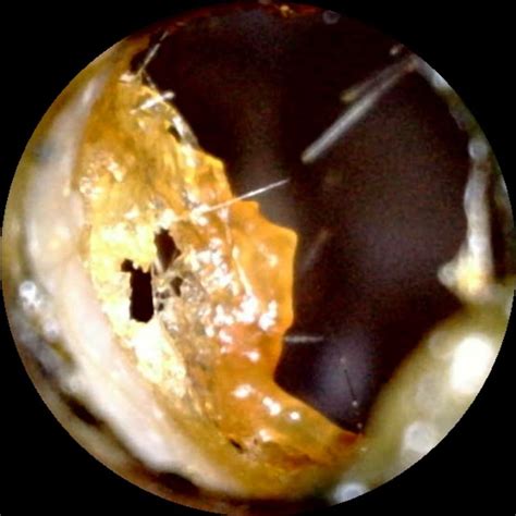 The Colour Of Ear Wax And Your Ear Health Ear View