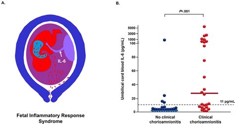 Clinical Chorioamnionitis At Term Definition Pathogenesis