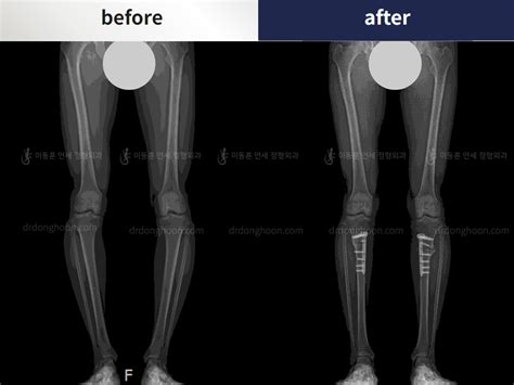 Bowlegs Correction Patient