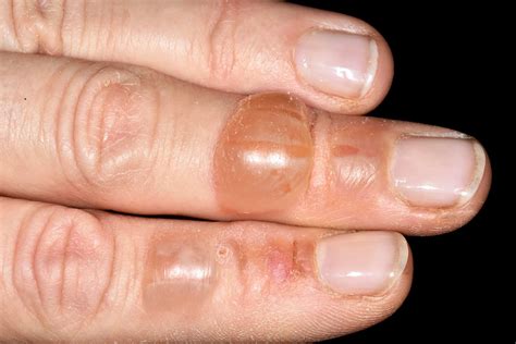 Blisters Pictures Of What They Look Like Symptoms Causes Treatment
