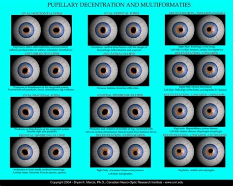 Human Pupil Decentration And Multiformaties Clinical Neuro Optic