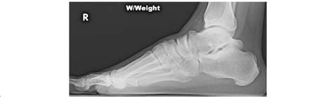A Lateral Radiograph Demonstrates An Elongated Posterolateral
