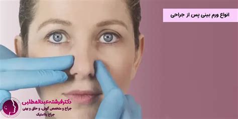 تورم بعد از جراحی بینی چه علتی دارد روش درمان دکتر فرشته عبدالمطلبی