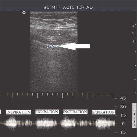 Doppler Can Collect Pulsatile Pleural Sounds In The Pleural Lines Download Scientific Diagram