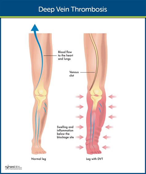 Soleus Muscle Trigger Point Anatomy Referred Pain Artofit