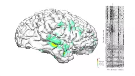 Epilepsy Brain Vs Normal Brain