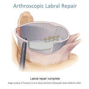 Shoulder Labral Tear Labral Repair And Rehabilitation Ashvin K Dewan MD Orthopedic Surgeon