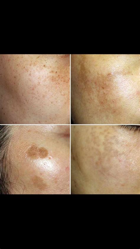 피부 잡티제거는 개인 살성과 병변에 따라 피코토닝 레이저토닝 혼합한 개인별 맞춤 프로그램으로 치료해야 합니다 부천 인천 얼굴잡티제거 피부과는 첨단 피코레이저로 The에서