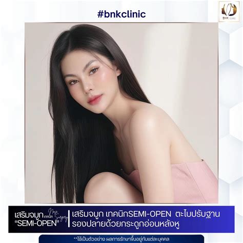 Bnk แก้ไขจมูกแบบ Semi Open Close หมอแก้ไขด้วยการเสริม พร้อมตะไบ เย็บอินเตอร์โดม รองปลาย