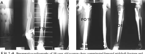 Figure 1 From Treatment Of Ipsilateral Femur And Tibia Fractures Semantic Scholar