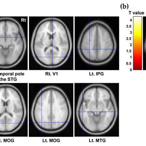 Results Of Voxel Based Partial Correlation Analysis Between The Raw Download Scientific Diagram
