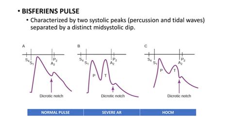 Pulse Arterial Pulse Types PPTX Heart And Cardiovascular Diseases Diseases And Conditions