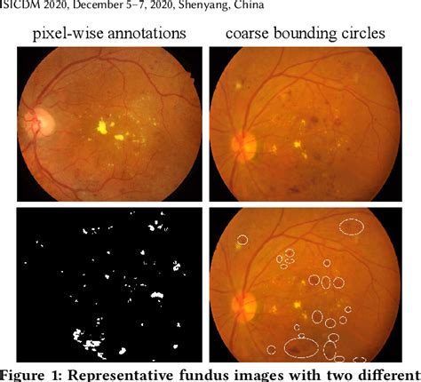 Figure 1 From Automated Diabetic Retinopathy Identification Via Lesion Guided Network Semantic