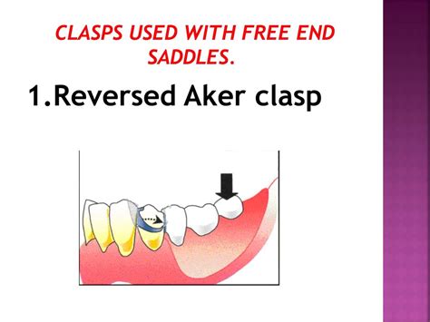 Ppt Planning The Design For Removable Partial Dentures Powerpoint