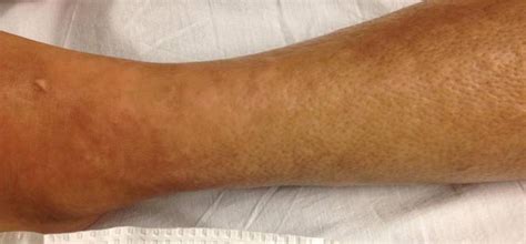 Eosinophilic Fasciitis