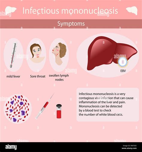 Infectious Mononucleosis Infectious Mononucleosis Stock Image