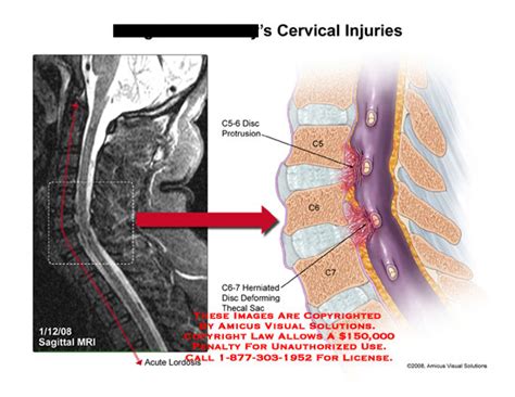 Amicus Illustration Of Amicusinjurycervicaldiscprotrusion